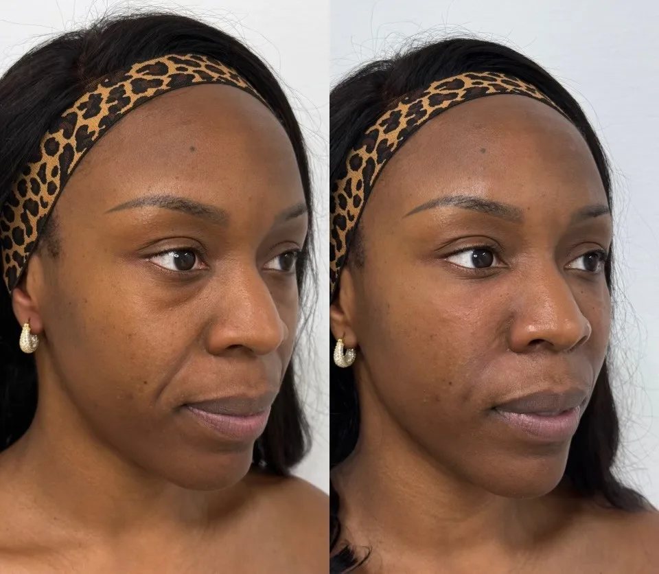 PRF EzGel Injection In Cypress, TX | Under Eye Filler